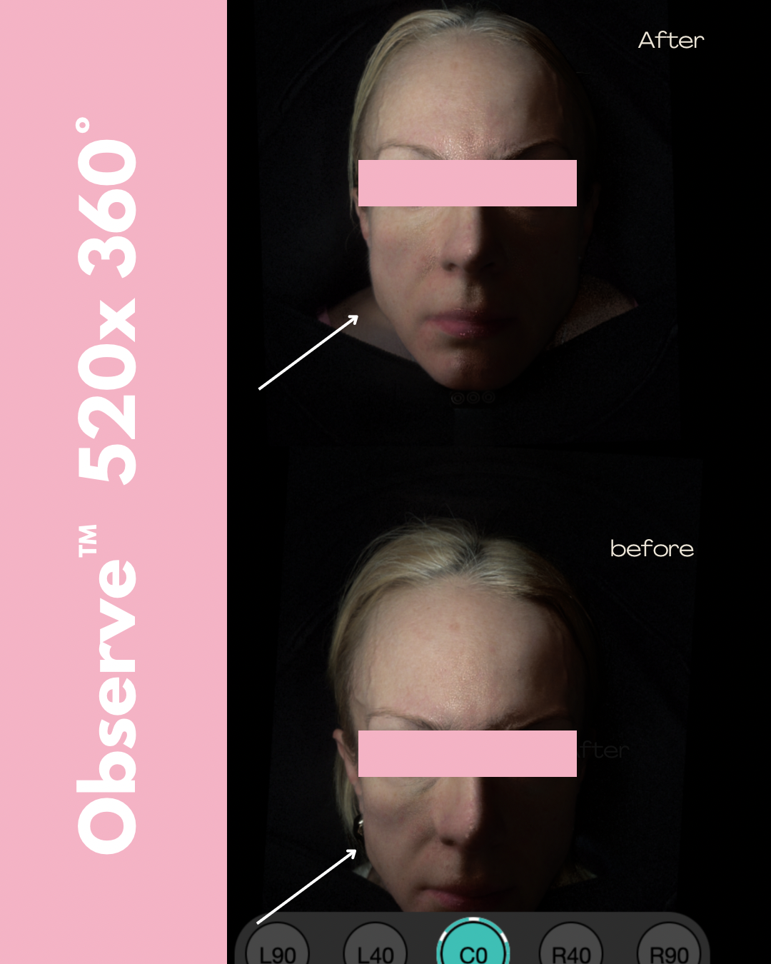 Best HIFU Sydney | Liftera HIFU Experts | Beauty Hub Sydney™ — Beauty ...