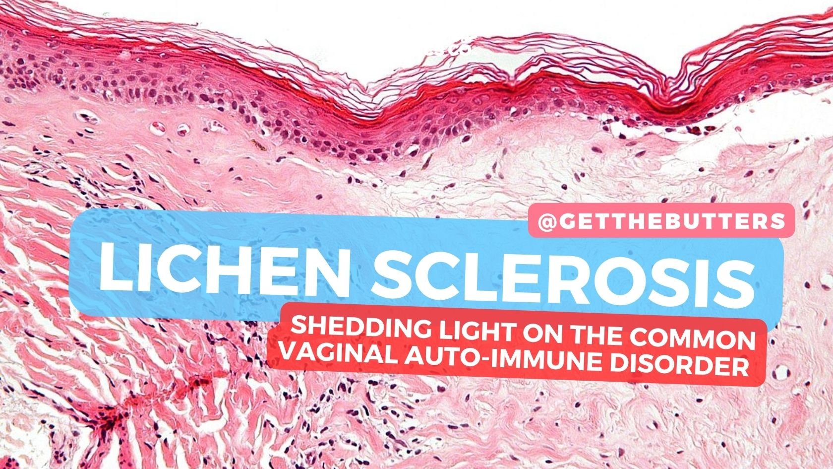 LICHEN SCLEROSIS: UNDERSTANDING THIS COMMON VAGINAL AUTO-IMMUNE DISORD – The Butters Hygienics Co.
