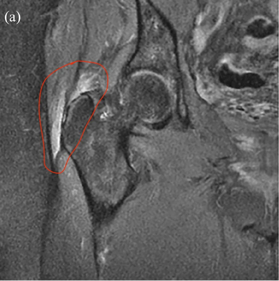 Ressonancia Magnetica De Bursite Trocanterica