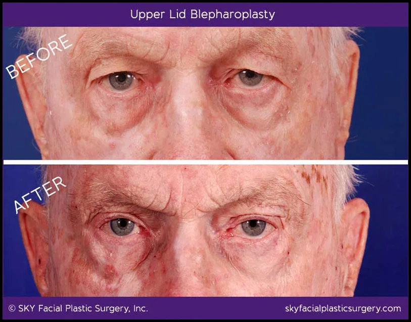 Identification of a Common Cause of Visual Impairment — SKY Facial ...