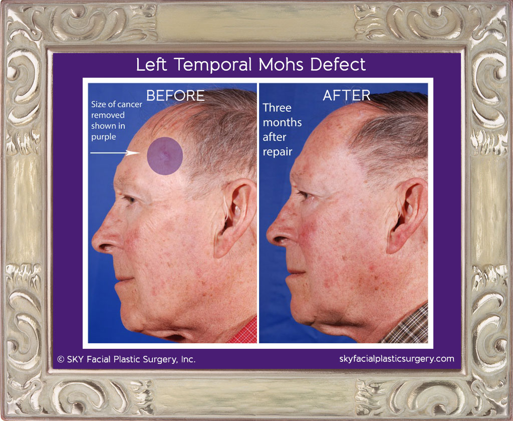 Mohs Reconstruction In San Diego After Skin Cancer — Sky Facial Plastic Surgery