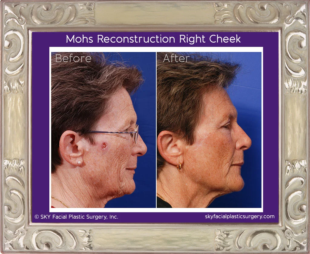 Mohs Reconstruction in San Diego after Skin Cancer — SKY Facial Plastic ...