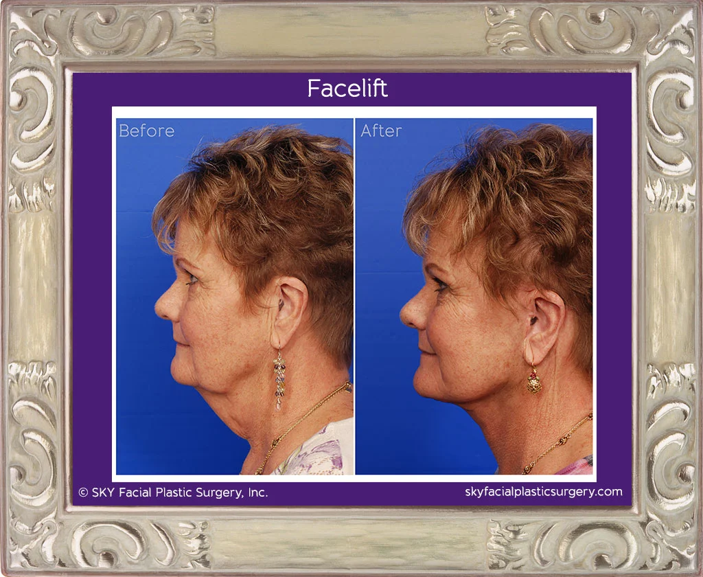 Mini-facelift, Mini Results? — SKY Facial Plastic Surgery