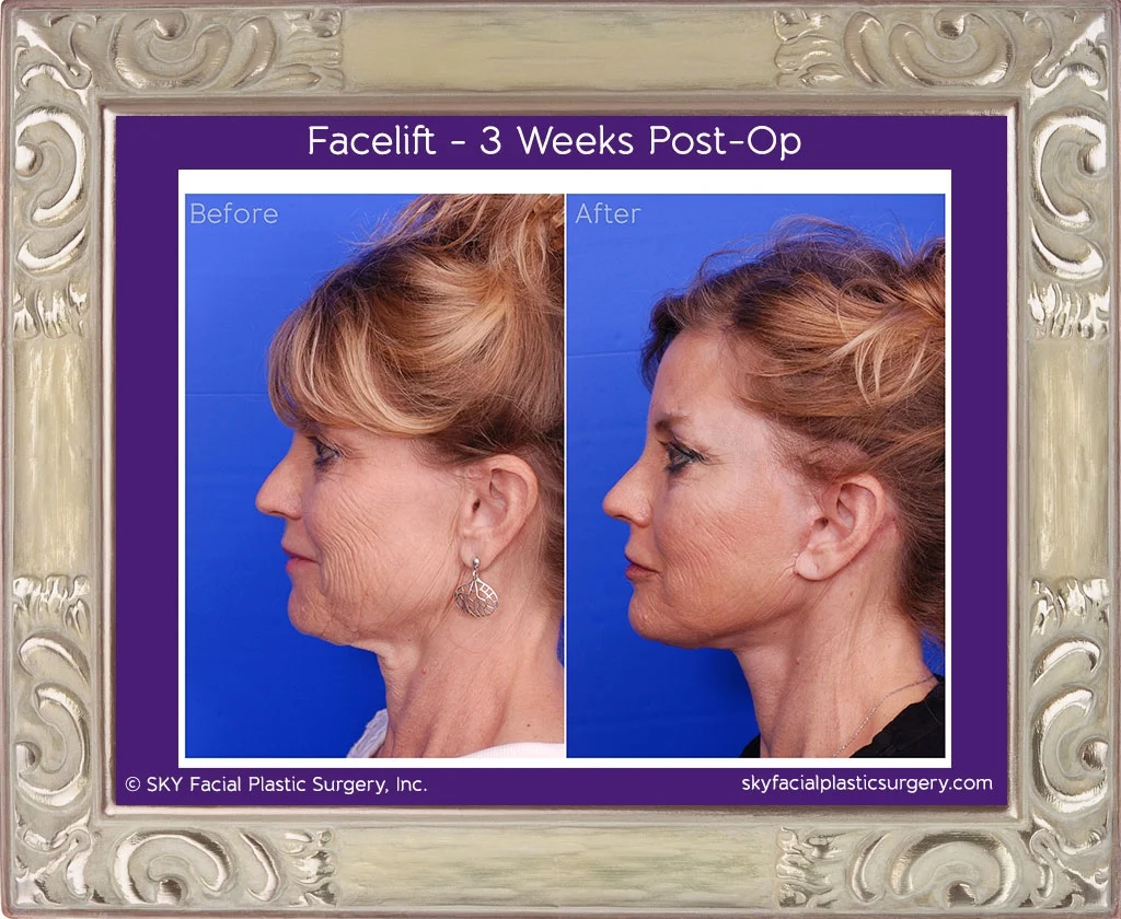 Mini-facelift, Mini Results? — SKY Facial Plastic Surgery