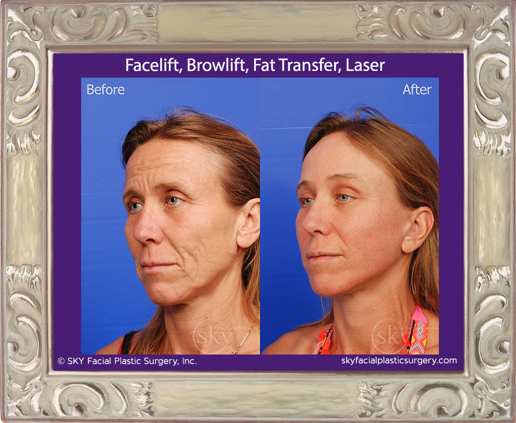 Browlift - San Diego's Best Browlift Surgeon — SKY Facial Plastic Surgery