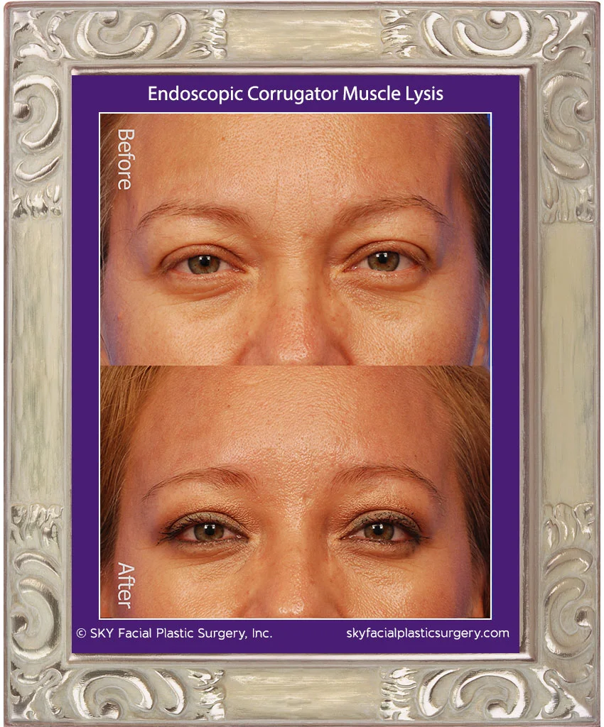 Corrugator Supercilii Expression