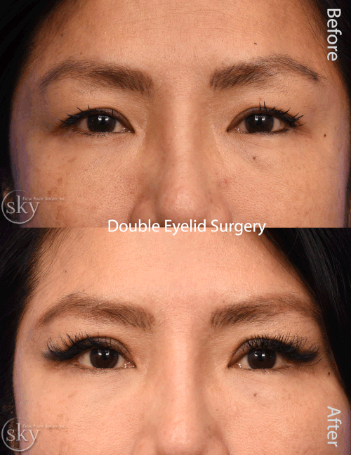 Single Eyelid Vs Double Eyelid