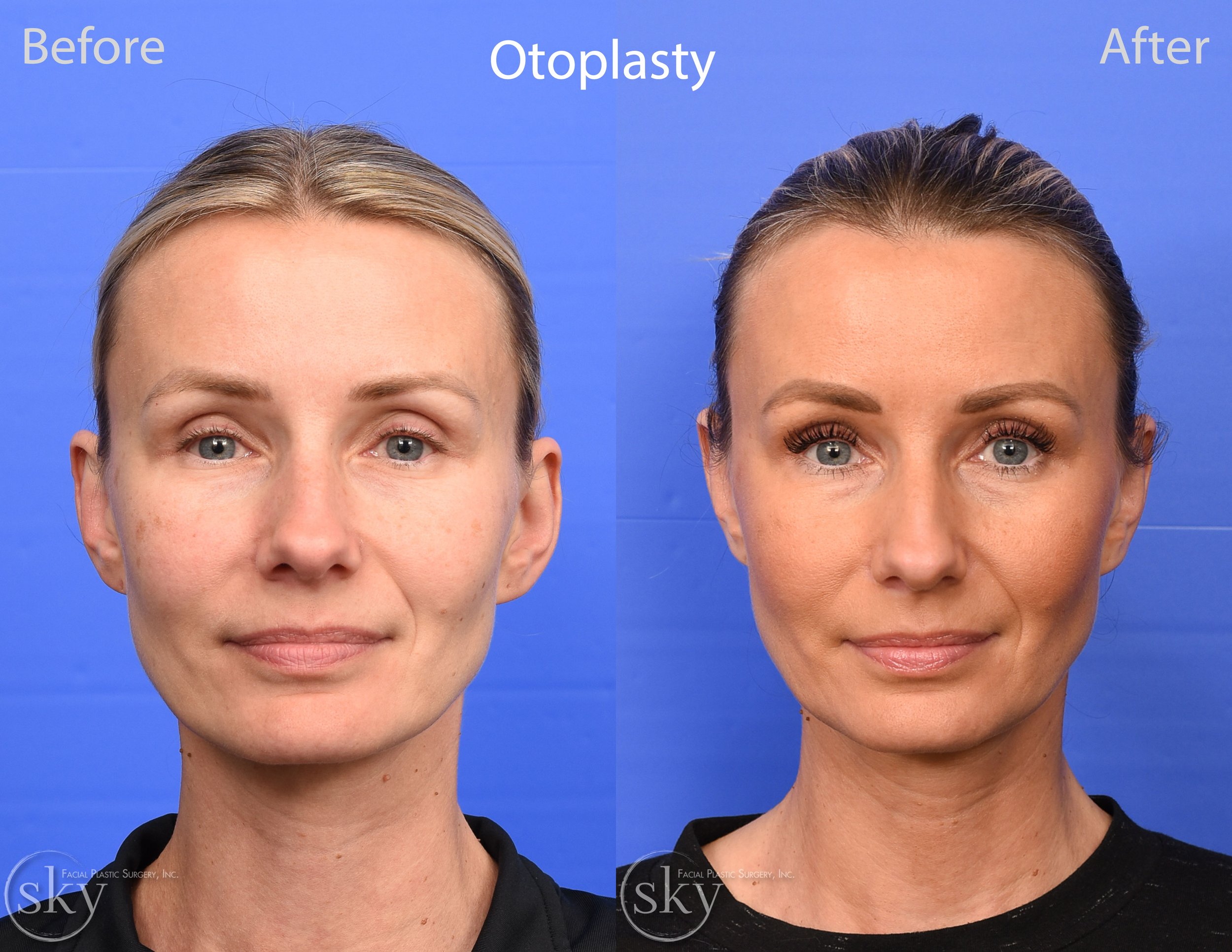 Otoplasty Before And After