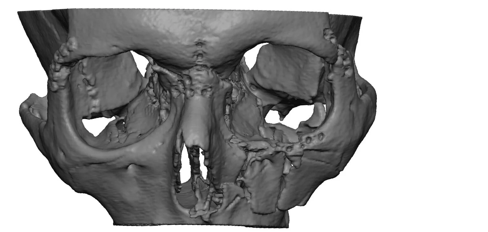 Surgical Case Study 1 - Zygomatic Osteotomy — Sean Peel