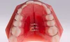 Orthopedic Appliances — Palo Alto Orthodontic Dentistry