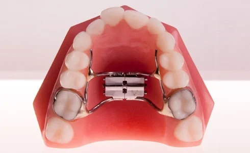Orthopedic Appliances — Palo Alto Orthodontic Dentistry