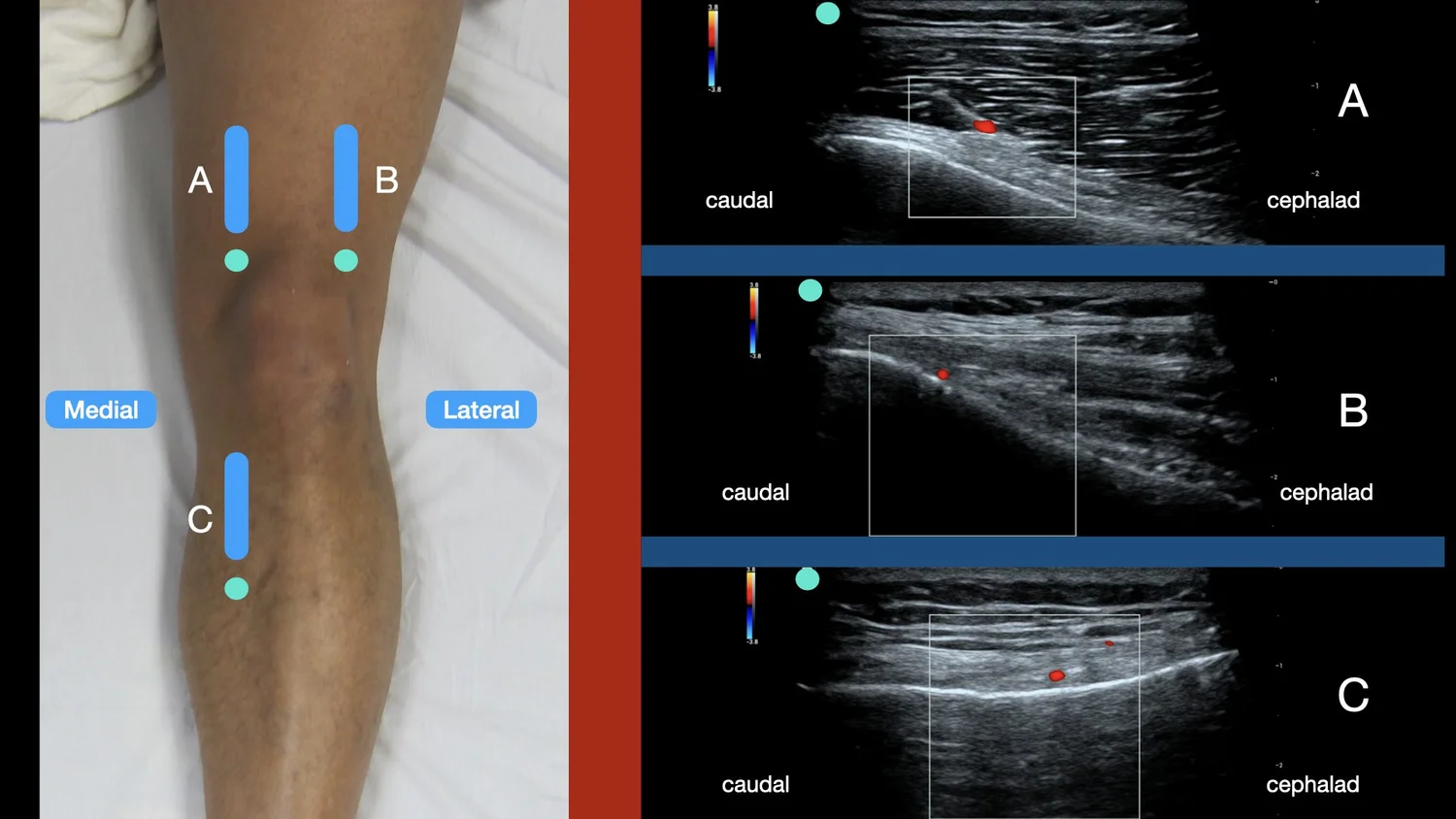 Genicular Nerve Block — Highland EM Ultrasound Fueled pain management