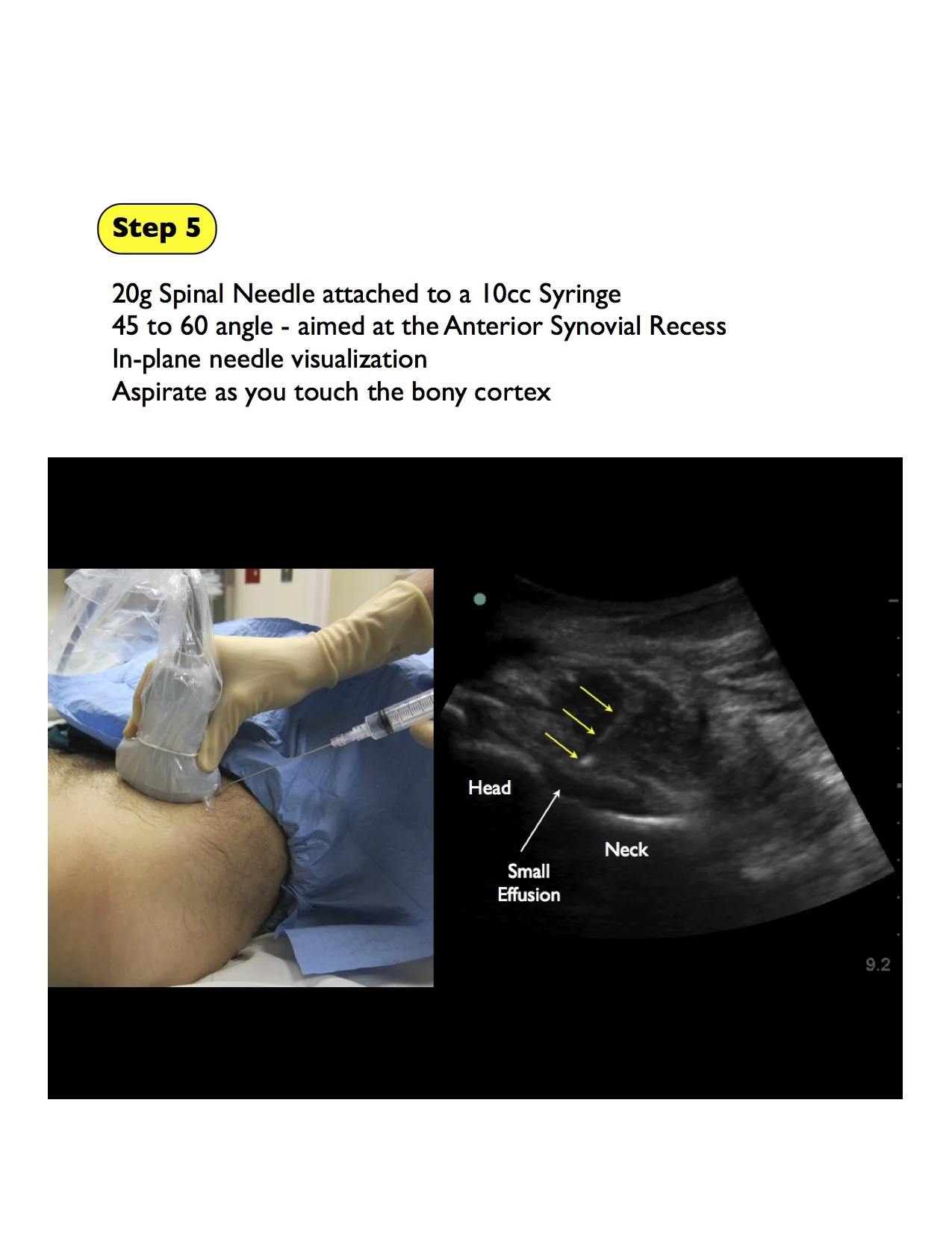 Arthrocentesis: Hip — Highland EM Ultrasound Fueled pain management