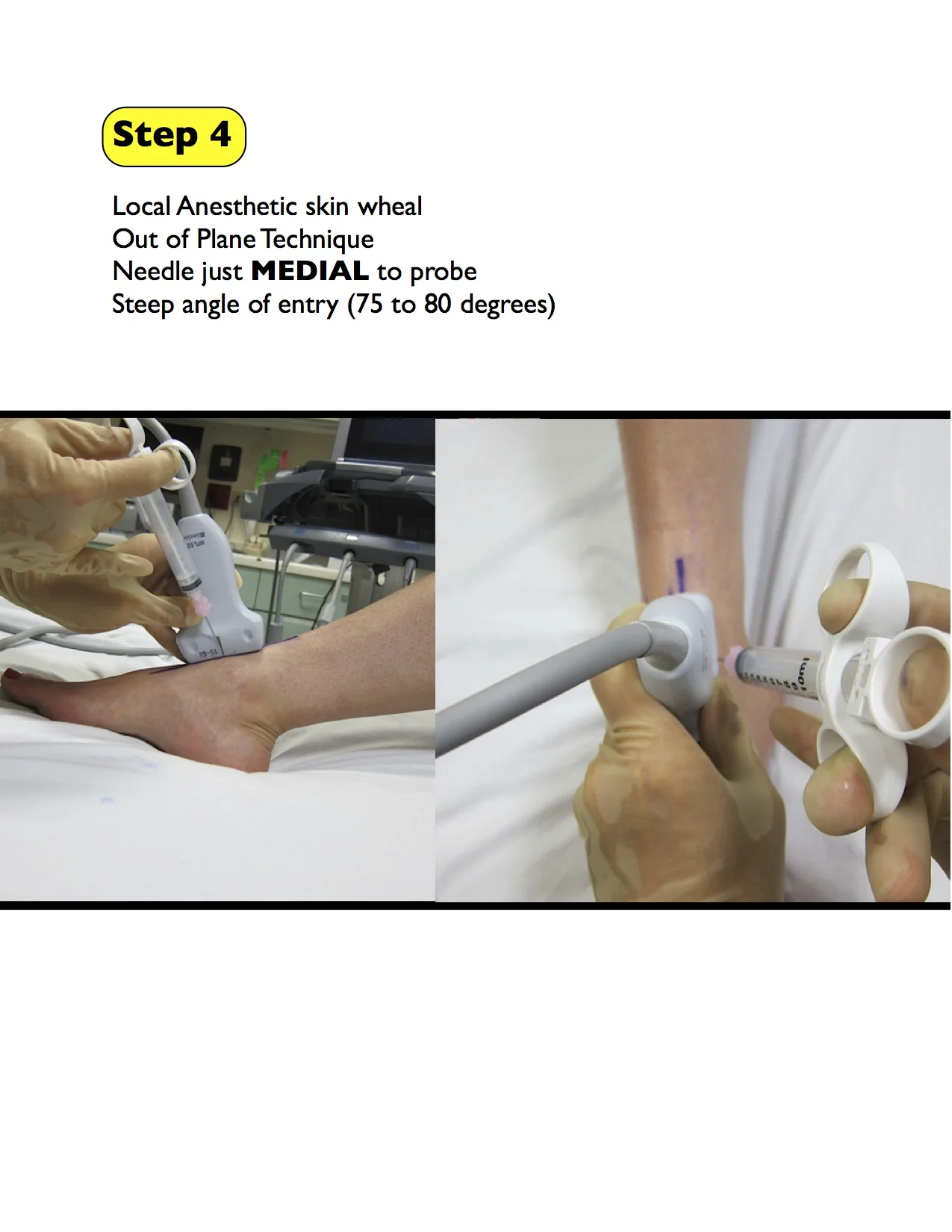 Arthrocentesis: Ankle — Highland EM Ultrasound Fueled pain management