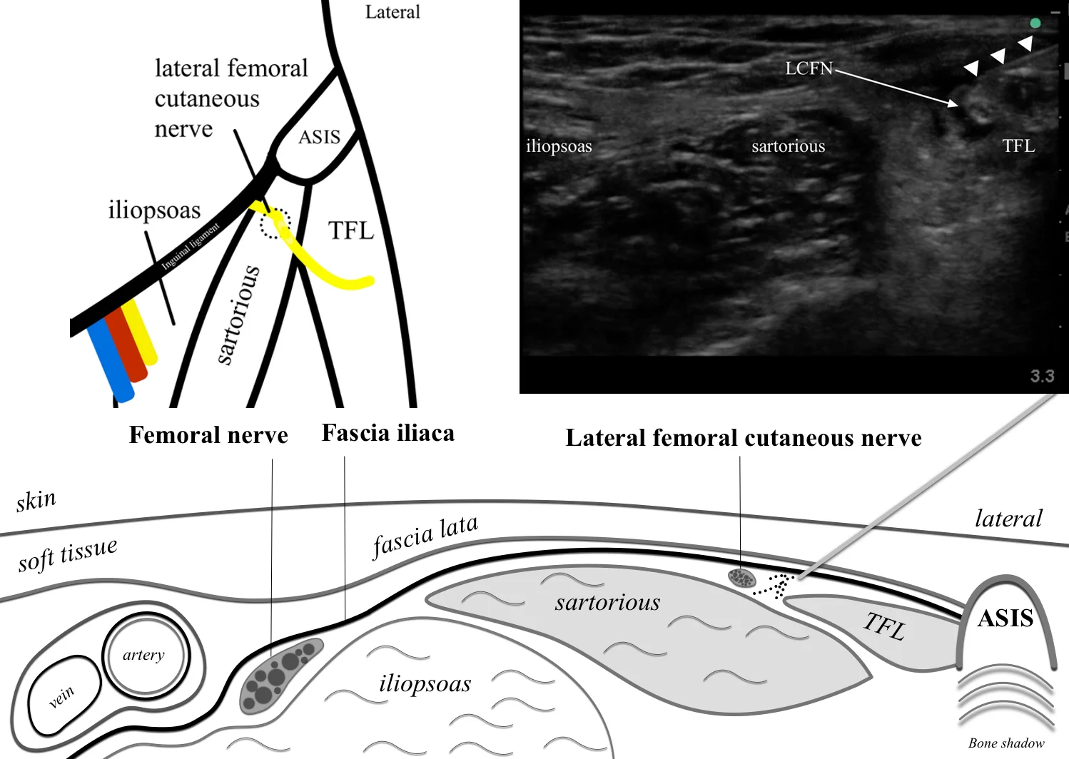 Lateral Femoral Cutaneous Nerve Injection Lateral Femoral Cutaneous Nerve Injection