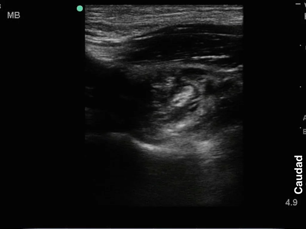 Axillary Nerve (deltoid) — Highland EM Ultrasound Fueled pain management