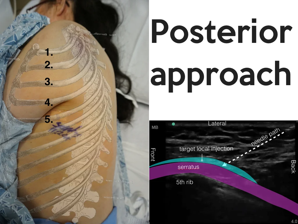 PECS/SERRATUS — Highland EM Ultrasound Fueled pain management