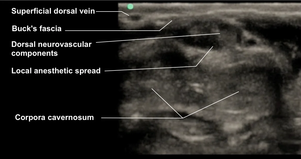 Penile block — Highland EM Ultrasound Fueled pain management
