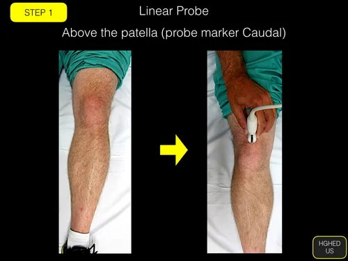 Arthrocentesis: Knee — Highland EM Ultrasound Fueled pain management
