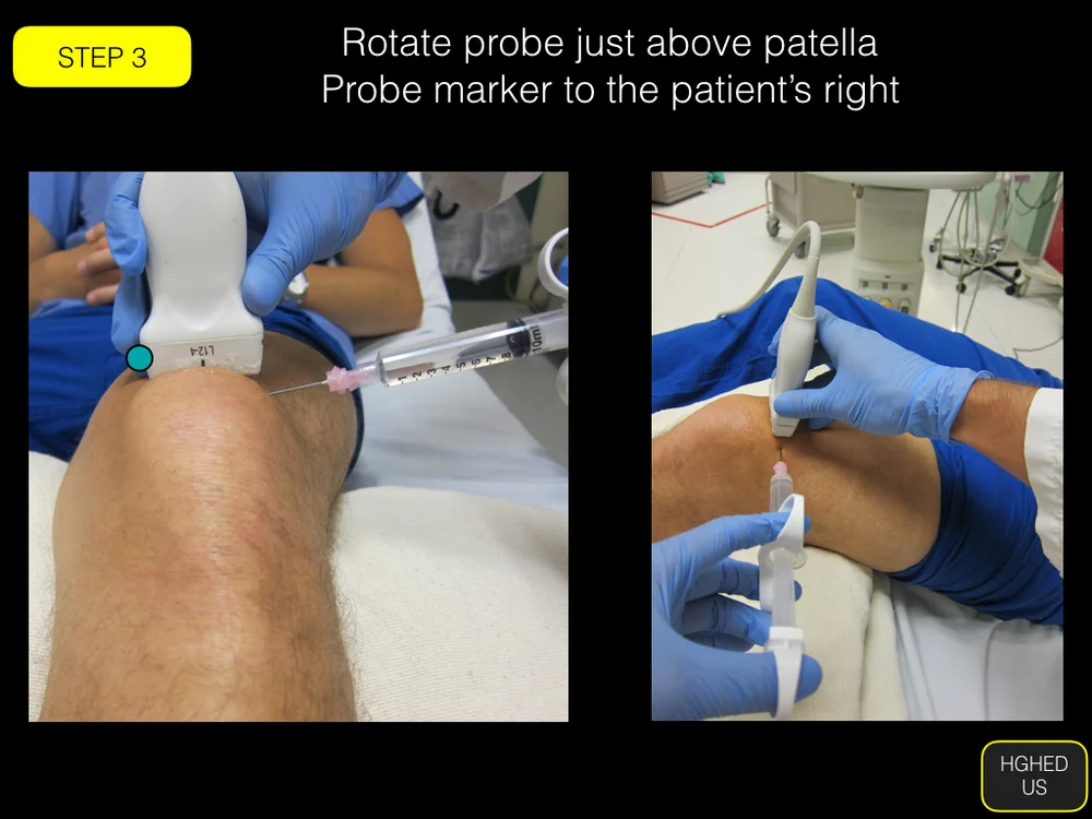 Arthrocentesis: Knee — Highland EM Ultrasound Fueled pain management