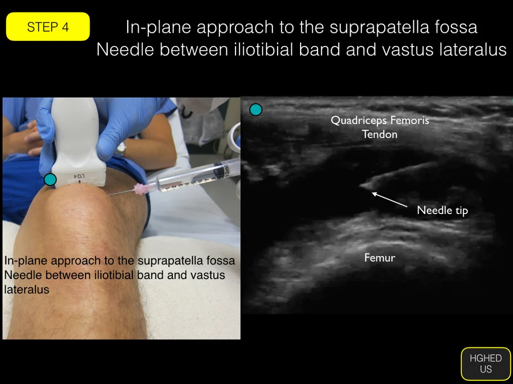 Arthrocentesis: Knee — Highland EM Ultrasound Fueled pain management