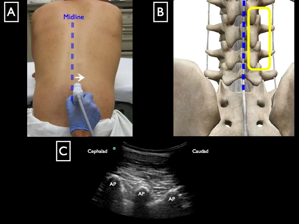Lumbar Puncture — Highland EM Ultrasound Fueled pain management