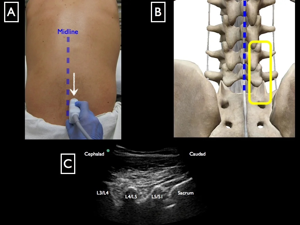 Lumbar Puncture — Highland EM Ultrasound Fueled pain management
