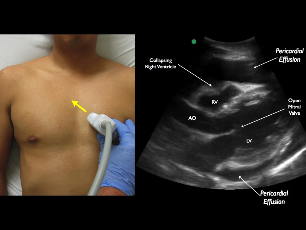 PERICARDIOCENTESIS — Highland EM Ultrasound Fueled pain management