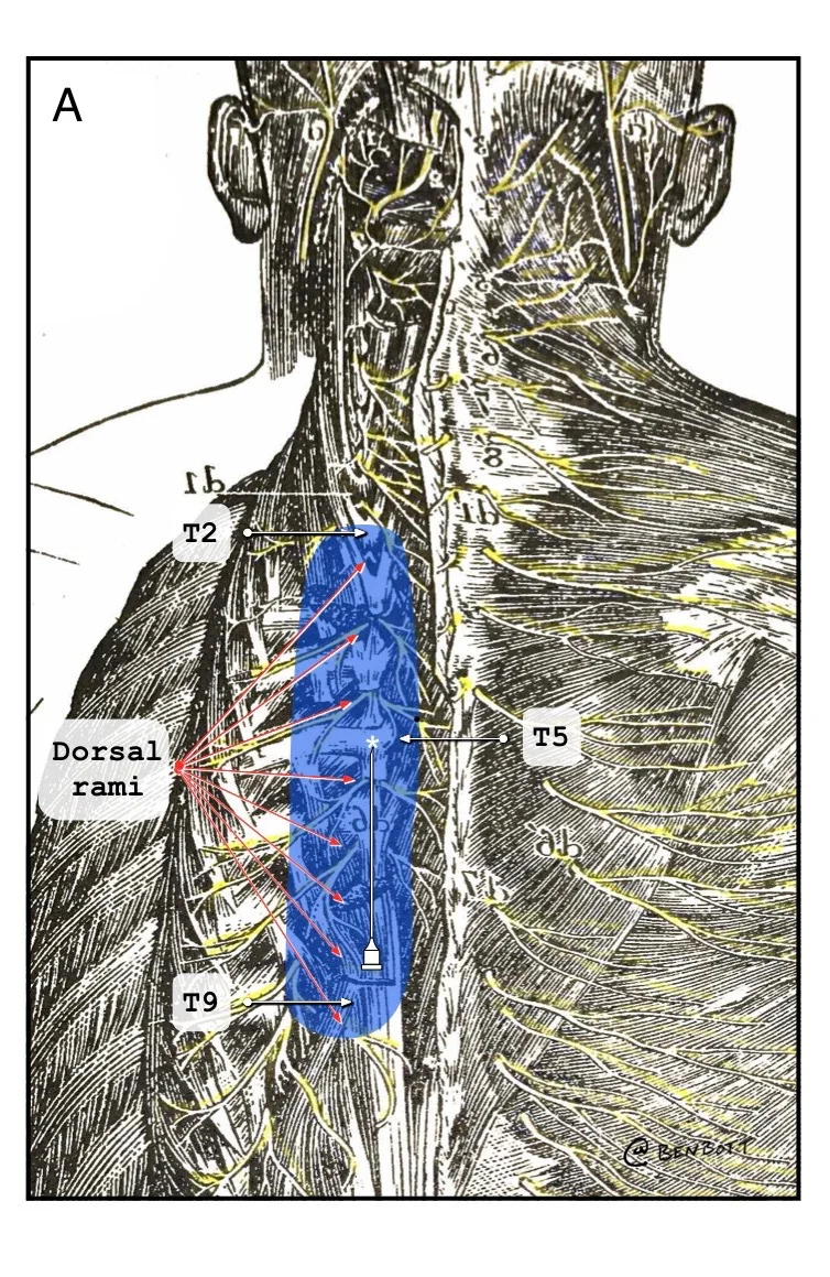ERECTOR — Highland EM Ultrasound Fueled pain management