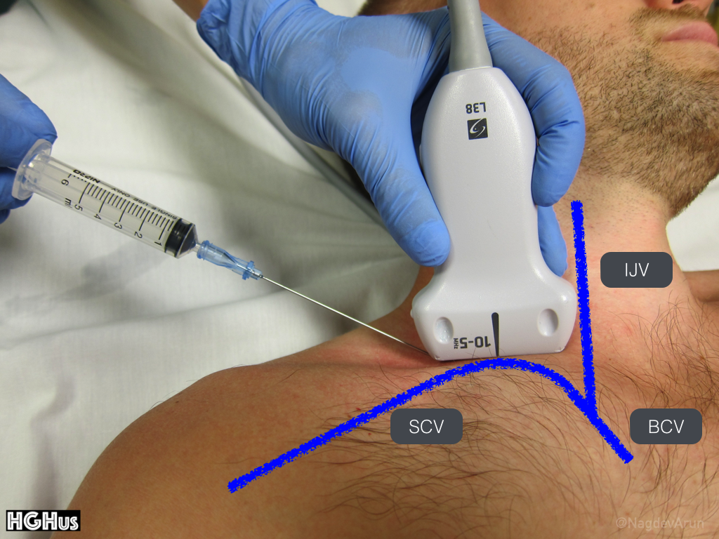 Supraclavicular Subclavian — Highland EM Ultrasound Fueled pain management