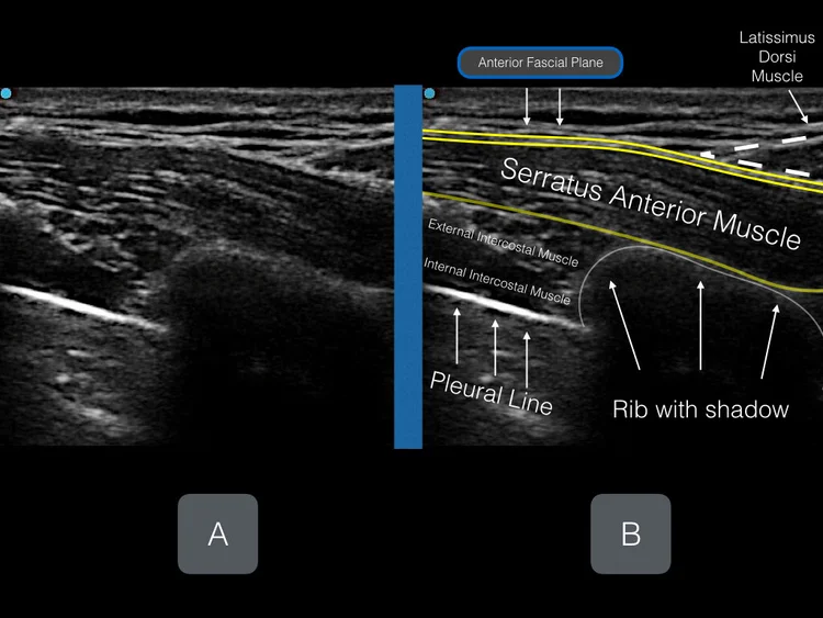Serratus Anterior Plane (EASY) — Highland EM Ultrasound Fueled pain ...