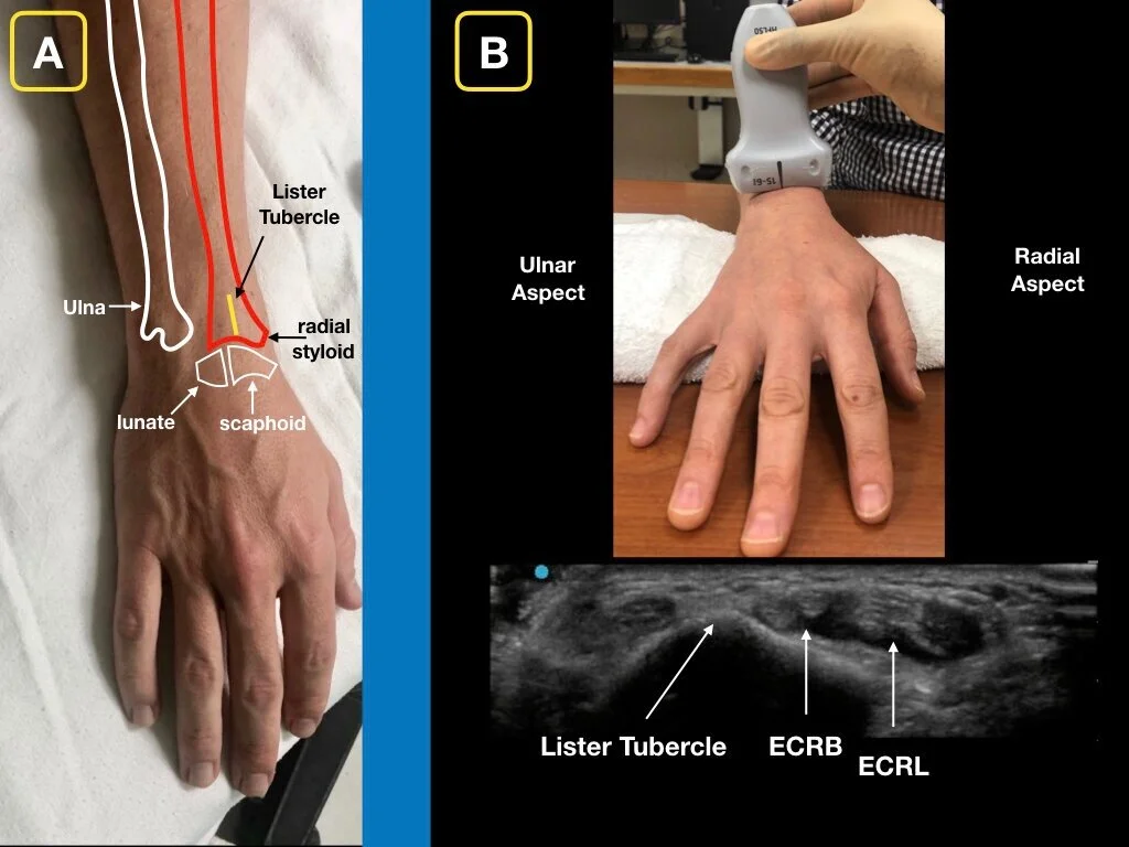 Wrist arthrocentesis — Highland EM Ultrasound Fueled pain management
