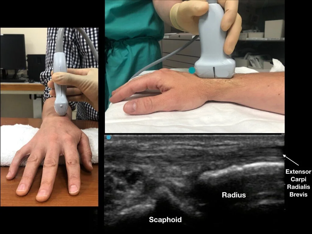 Wrist arthrocentesis — Highland EM Ultrasound Fueled pain management