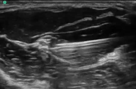 Forearm blocks — Highland EM Ultrasound Fueled pain management