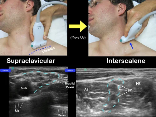 Interscalene — Highland EM Ultrasound Fueled pain management