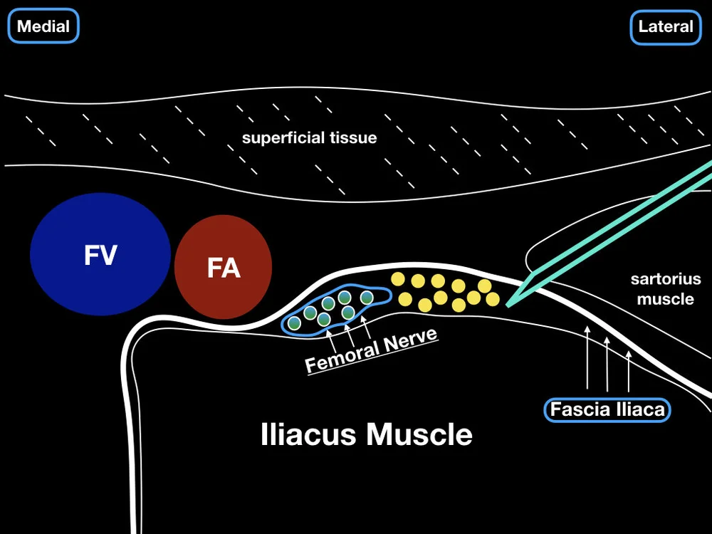 Infrainguinal Fascia Iliaca Plane Block ( AKA : Femoral Nerve Block ...