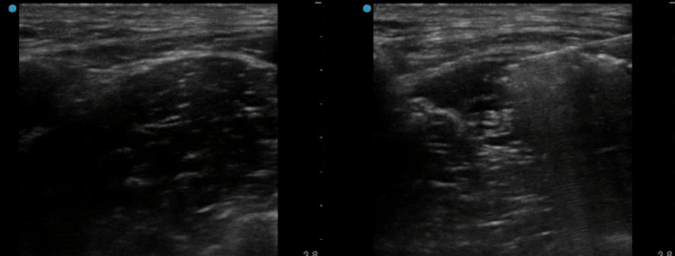 Infrainguinal Fascia Iliaca Plane Block ( AKA : Femoral Nerve Block ...
