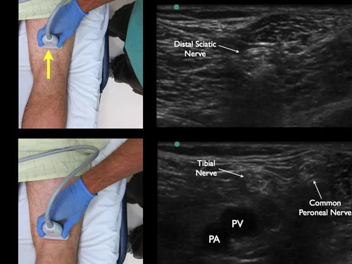 Pop Block - Popliteal Sciatic Block — Highland EM Ultrasound Fueled ...