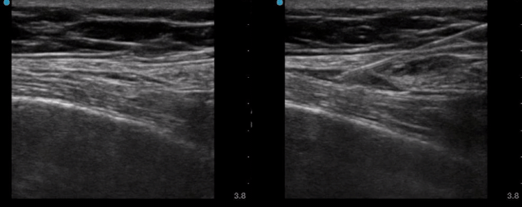 Serratus Anterior Plane (EASY) — Highland EM Ultrasound Fueled pain ...