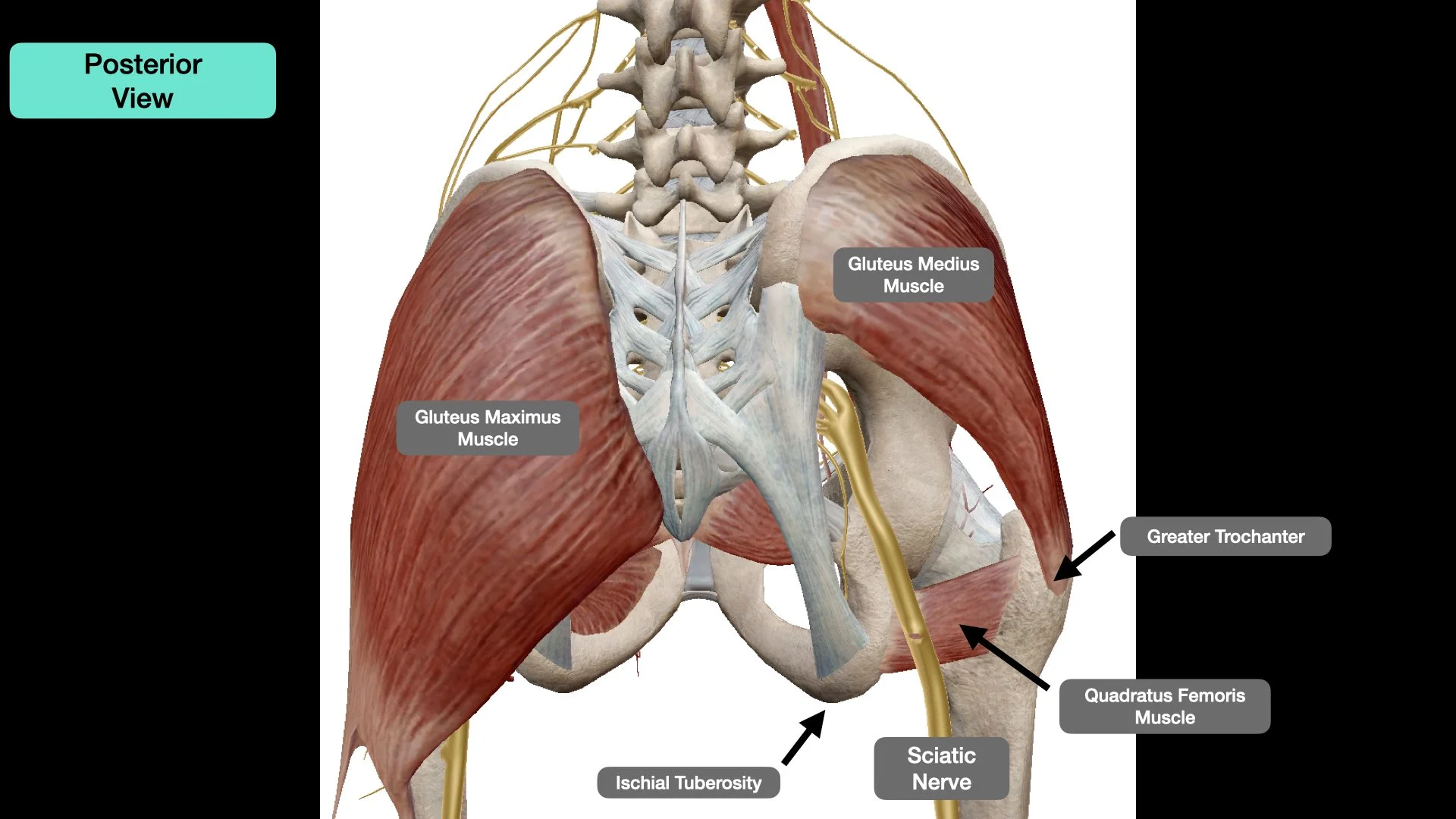 Transgluteal Sciatic Nerve Block — Highland EM Ultrasound Fueled pain ...