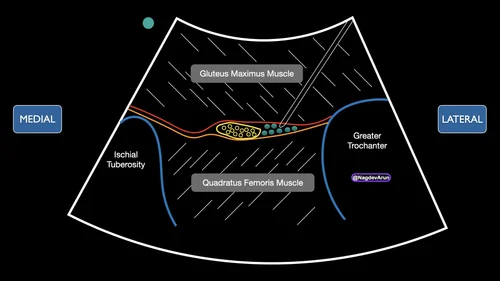 Transgluteal Sciatic Nerve Block — Highland EM Ultrasound Fueled pain ...