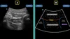 Transgluteal Sciatic Nerve Block — Highland EM Ultrasound Fueled pain ...