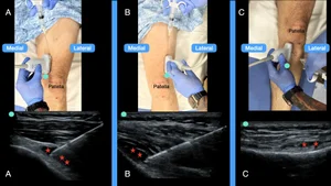 Genicular Nerve Block — Highland EM Ultrasound Fueled pain management