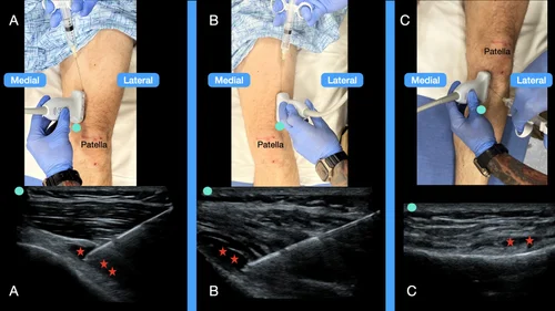 Genicular Nerve Block — Highland EM Ultrasound Fueled pain management