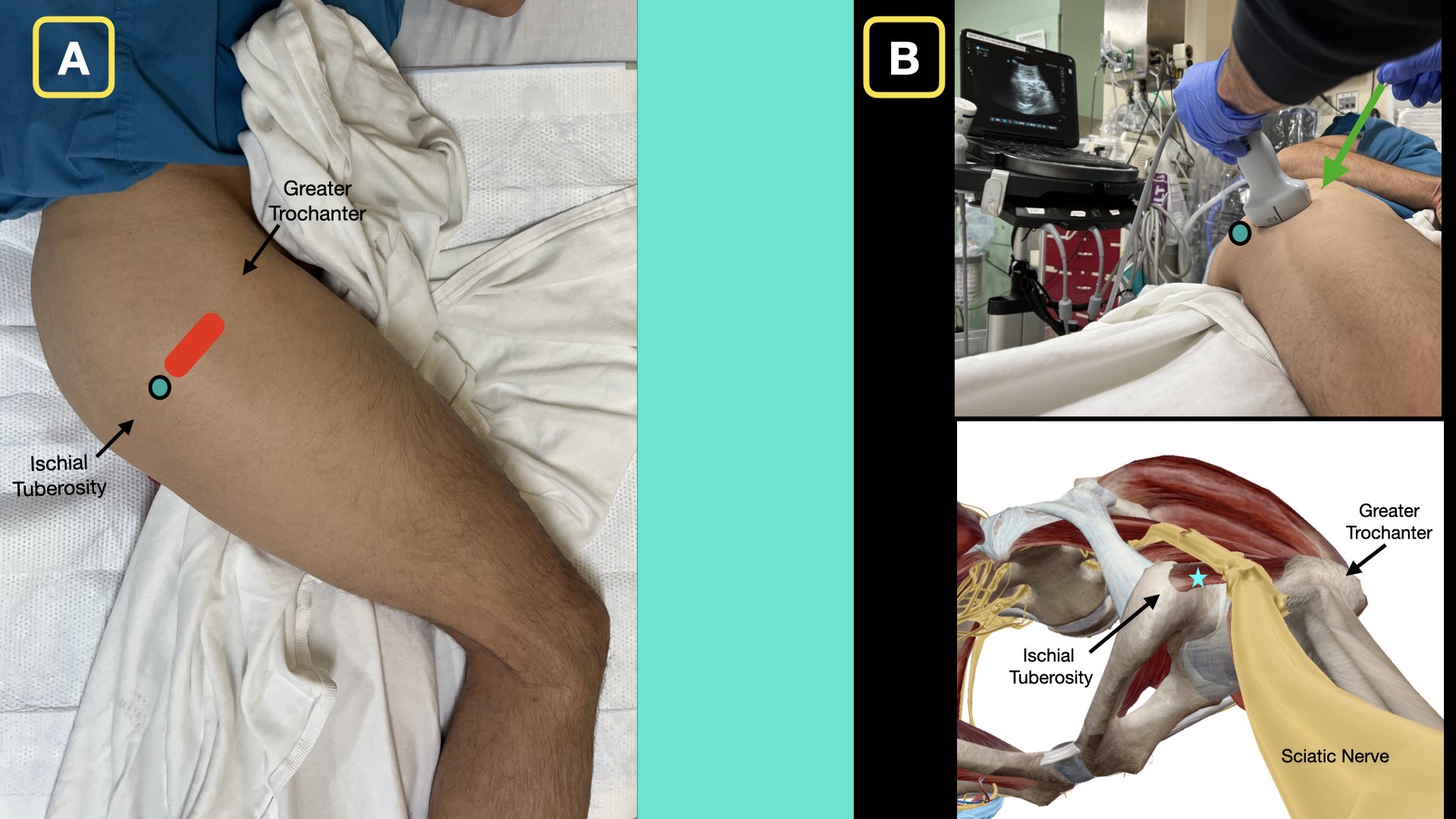 Transgluteal Sciatic Nerve Block — Highland EM Ultrasound Fueled pain management