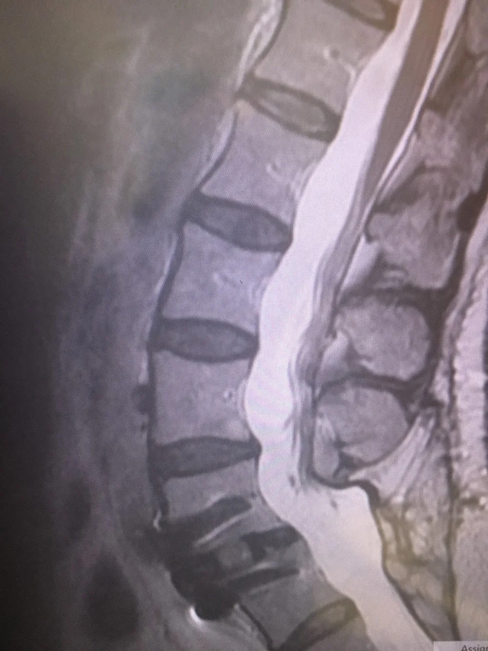 Chiropractic Before or After a Spinal Injection: The Facts! — The ...
