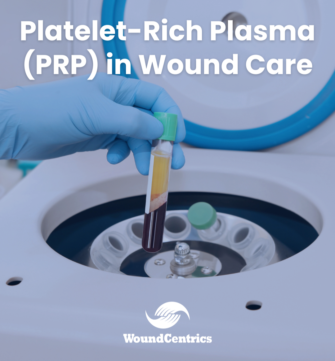 Platelet-Rich Plasma (PRP) in Wound Care — WoundCentrics, LLC