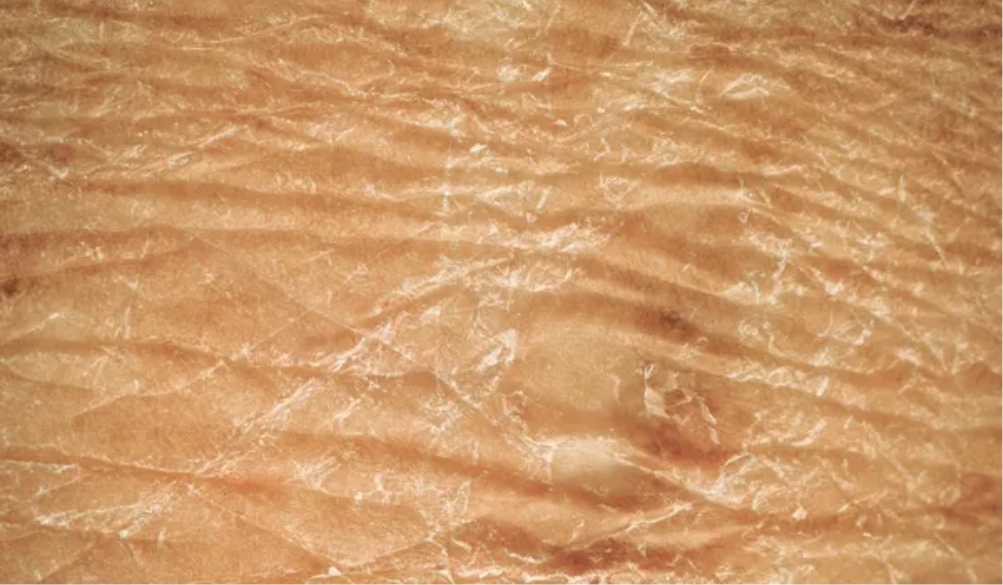 Vitamin K: A Breakthrough Treatment for Calciphylaxis — WoundCentrics, LLC