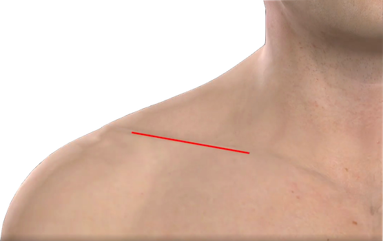 Fratura da clavícula — Dr. Mauro Gracitelli
