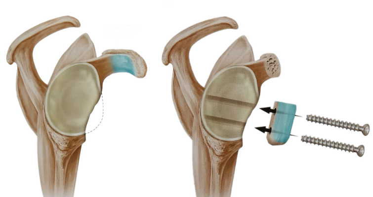 Procedimento de Latarjet para luxação do ombro — Dr. Mauro Gracitelli